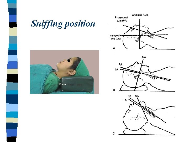 ENDOTRACHEAL INTUBATION Thida Uakritdathikarn MD Department Of ...