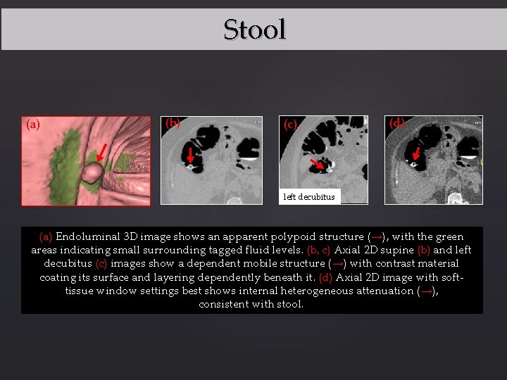 CT Colonography Improving Interpretive Skill by Avoiding Pitfalls