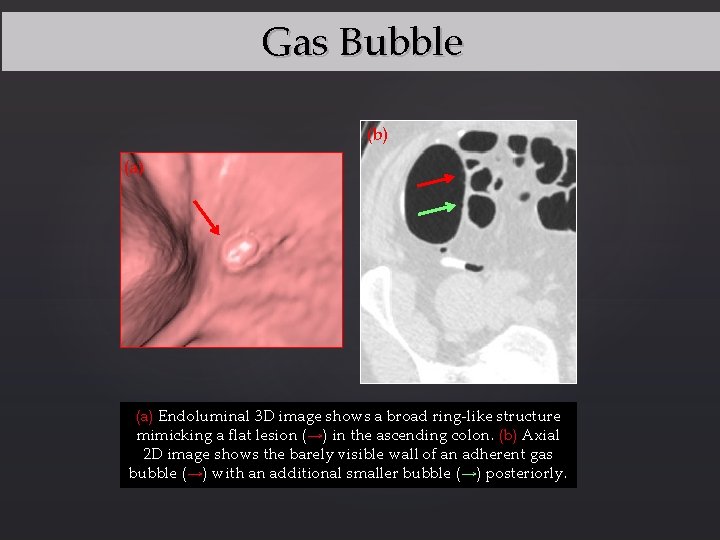 CT Colonography Improving Interpretive Skill by Avoiding Pitfalls