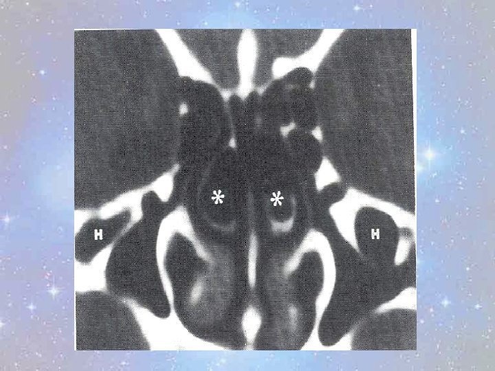 OMU FESS AND WHAT THE RADIOLOGIST NEED TO