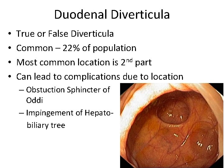 Diverticula of the Alimentary Tract Aaron Sinclair MD