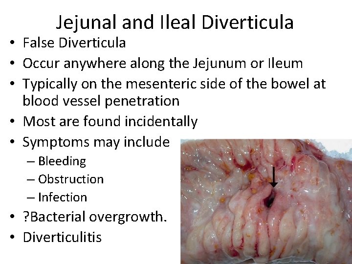 Diverticula of the Alimentary Tract Aaron Sinclair MD