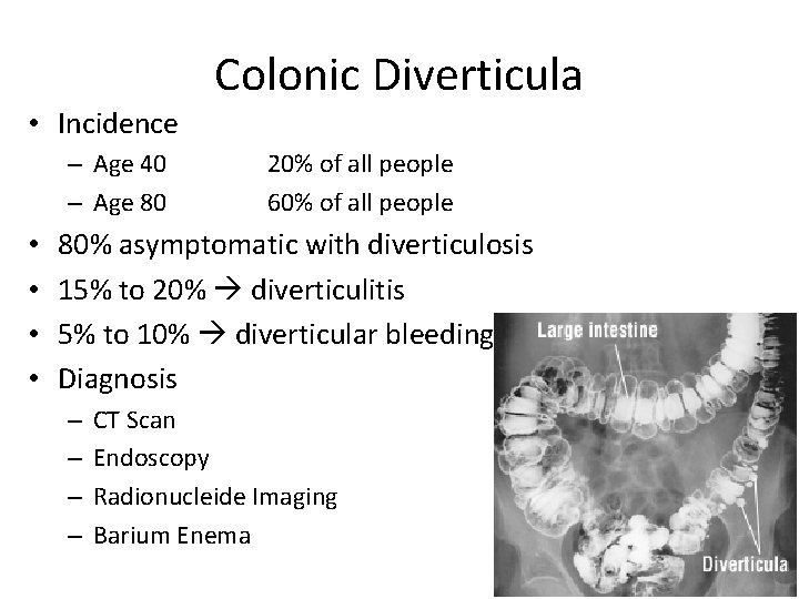 Diverticula of the Alimentary Tract Aaron Sinclair MD