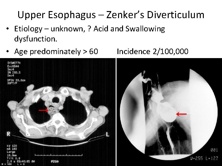Diverticula of the Alimentary Tract Aaron Sinclair MD