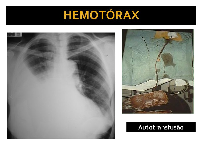 ATENDIMENTO INICIAL AO POLITRAUMATIZADO Suporte Avanado de Vida