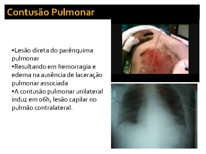 ATENDIMENTO INICIAL AO POLITRAUMATIZADO Suporte Avanado de Vida