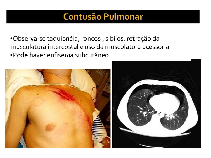 ATENDIMENTO INICIAL AO POLITRAUMATIZADO Suporte Avanado de Vida
