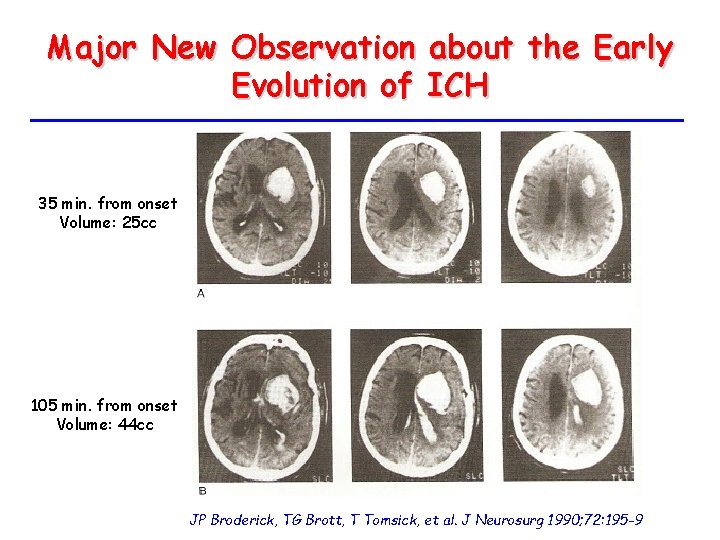 INTRACEREBRAL HEMORRHAGE UPDATE Carlos S Kase MD Neurology