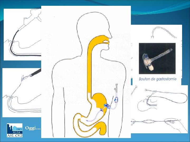 INDICAZIONI ALLE ENTEROSTOMIE E COLOSTOMIE Vincenzo ADAMO Dirigente
