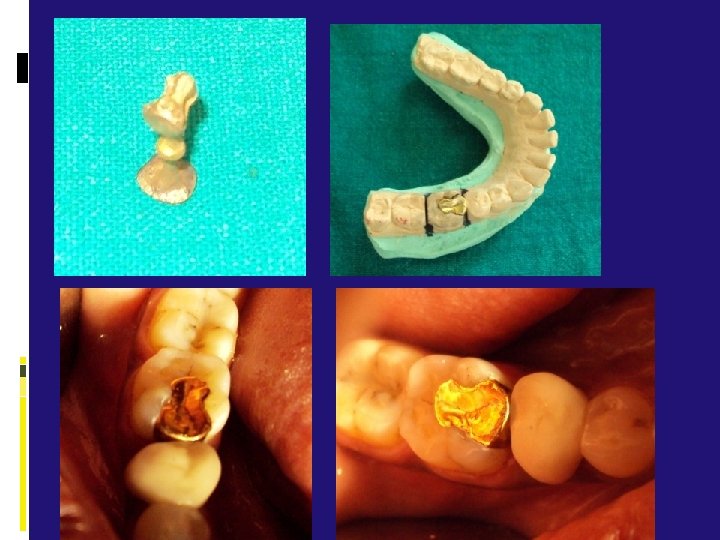 Cast Metal Restorations Dr S Mukhtarun Nisar Andrabi