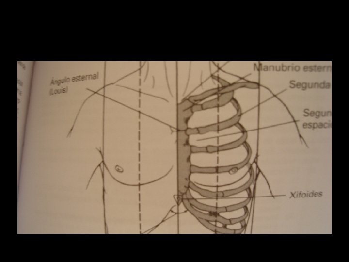 TORAX Paciente sentado Con el torso desnudo Paciente