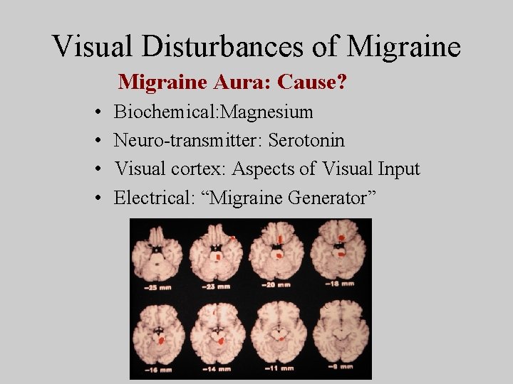 The NeuroOphthalmology of Headache Charles E Maxner MD
