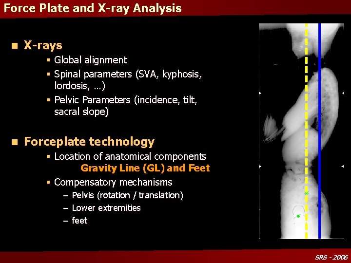 Impact of sagittal plane spinal deformity on the