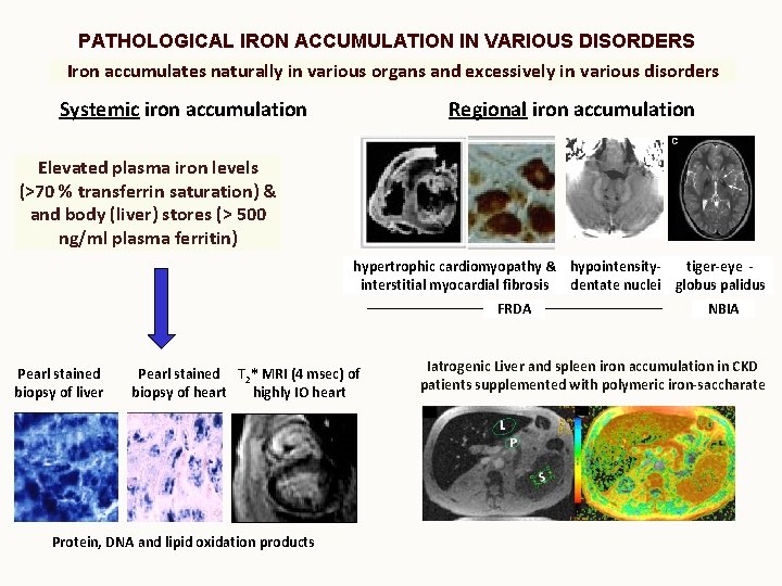 The metabolic effects of excess iron and its