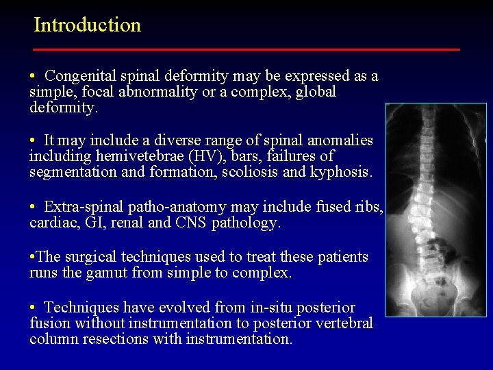 Treatment for Congenital Scoliosis due to Hemivertebrae A
