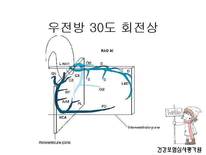 PTCA Percutaneous Transluminal Coronary Angioplasty L Main left