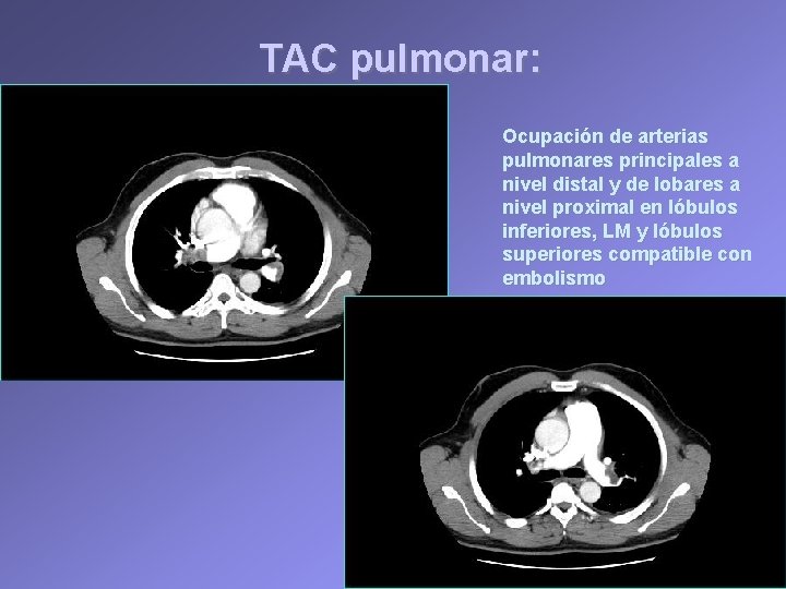 EMBOLISMO PULMONAR Nerea Garate Villanueva Residente MFy C