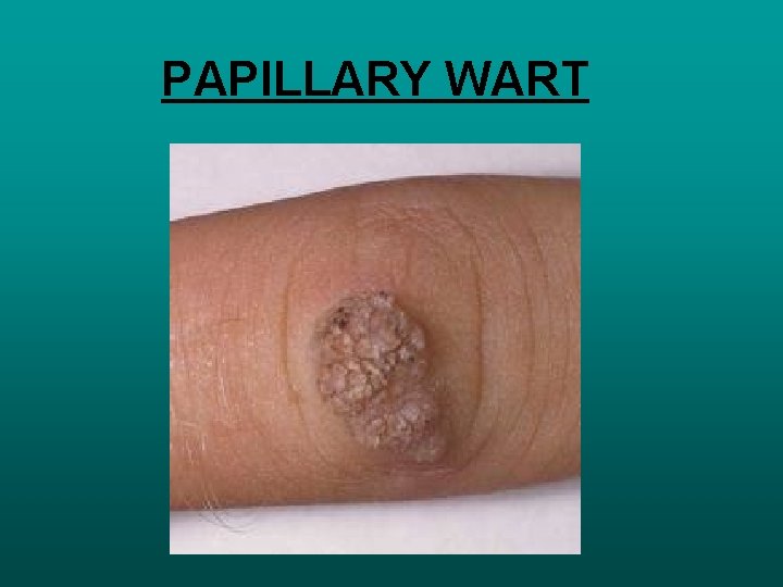 SKIN TUMOURS DR IMRANA ZULFIKAR ASSITANT PROFESSOR SURGERY