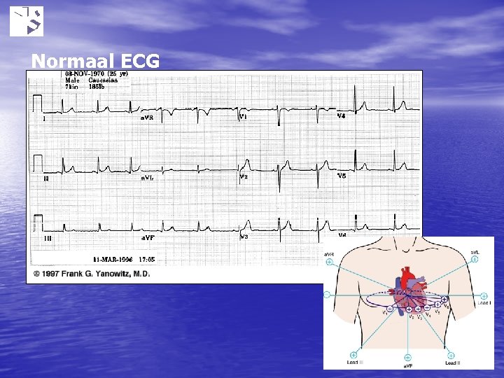 Presentatie Myocardinfarct diagnostiek afleidingen ECG 12 Doelstelling ...