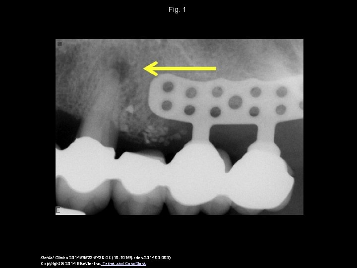 Cone Beam Computed Tomography Updated Technology for Endodontic