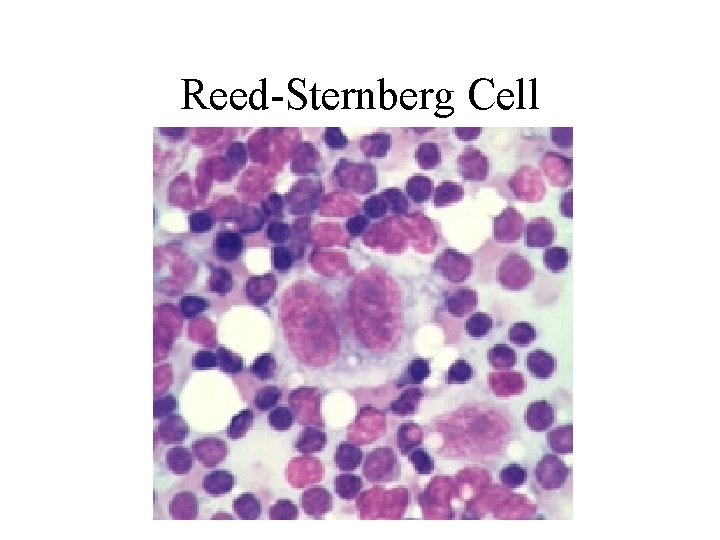 Lymphomas The Basics Brad Kahl MD Assistant Professor