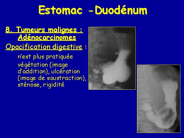 Imagerie du tube digestif Smiologie DCEM 1 Imagerie