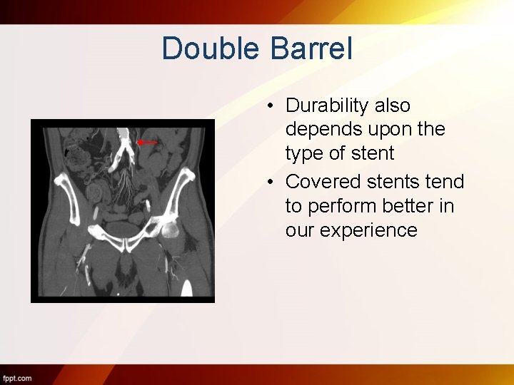 CRT 2016 Endovascular Intervention of Aortoiliac Bifurcation Disease