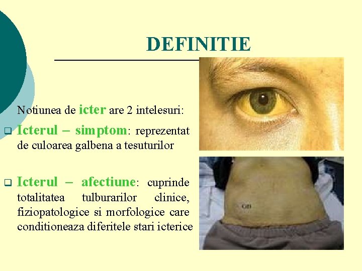 SINDROMUL ICTERIC DEFINITIE Coloratia galbena a tegumentelor si