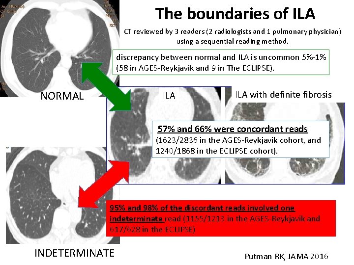 ILA interstitial lung abnormalities prevalence and clinical relevance