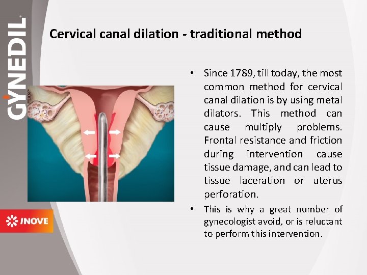 OVERVIEW Cervical canal dilation problem and its traditional