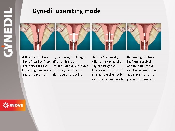 OVERVIEW Cervical canal dilation problem and its traditional