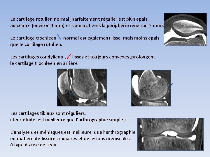 APPORT DE LARTHROSCANNER DANS LA PATHOLOGIE DU GENOU