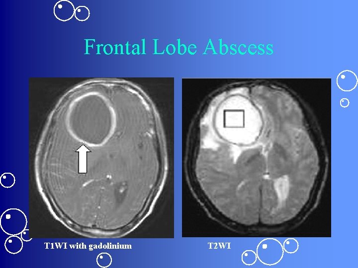 RingEnhancing Lesion in Right Deep Frontal Lobe Clinical