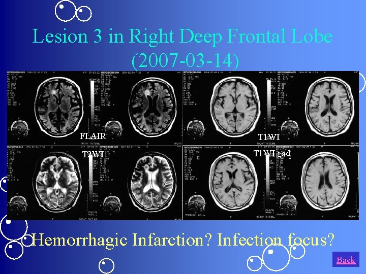 RingEnhancing Lesion in Right Deep Frontal Lobe Clinical
