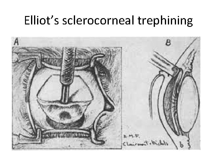 SURGICAL PROCEDURES IN GLAUCOMA Dr Vivekanand U APPLIED