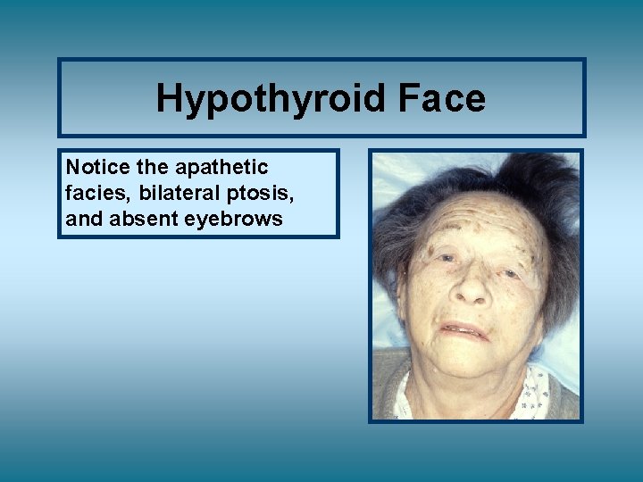 Hypothyroidism Signs and Symptoms Classic Teaching v v