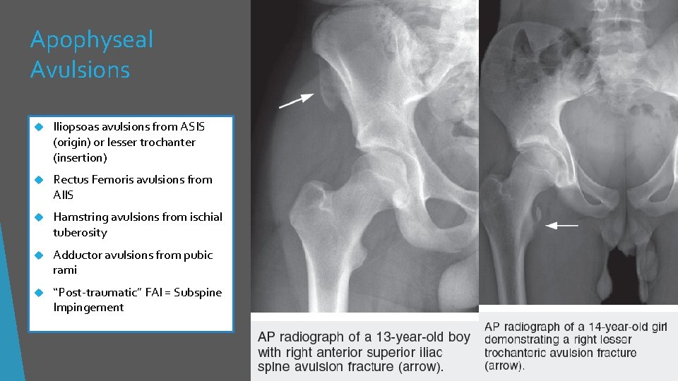 HIP INJURIES IN ATHLETES Focus on Femoroacetabular Impingement