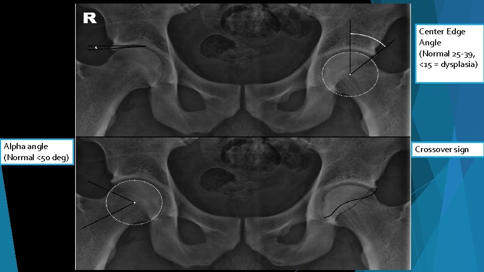 HIP INJURIES IN ATHLETES Focus on Femoroacetabular Impingement