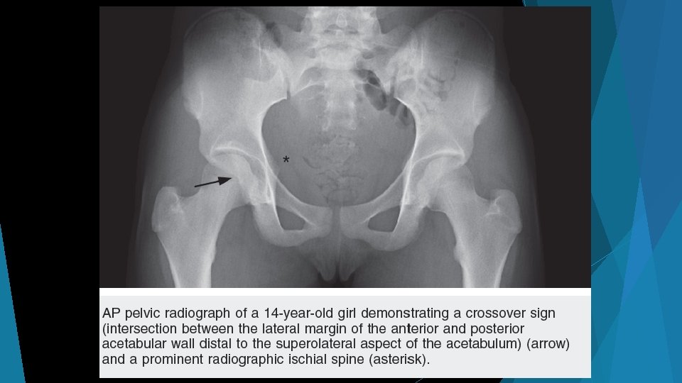 HIP INJURIES IN ATHLETES Focus on Femoroacetabular Impingement