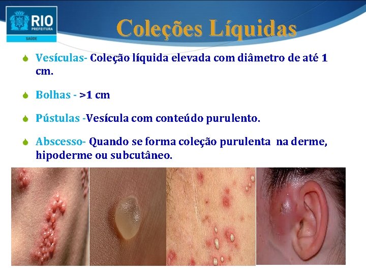 LESES ELEMENTARES EM DERMATOLOGIA 2016 Mcula ou Mancha