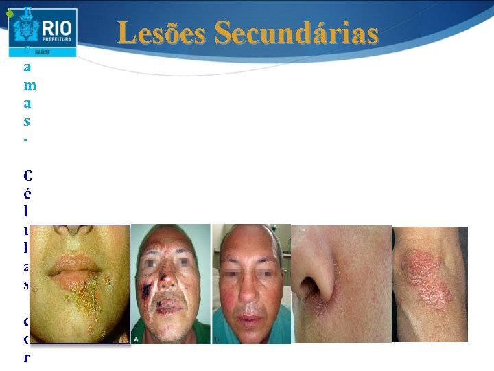 LESES ELEMENTARES EM DERMATOLOGIA 2016 Mcula ou Mancha