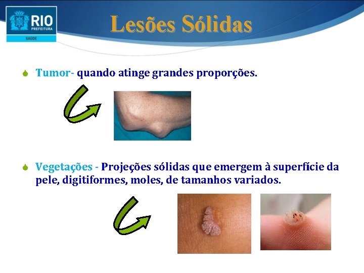 LESES ELEMENTARES EM DERMATOLOGIA 2016 Mcula ou Mancha