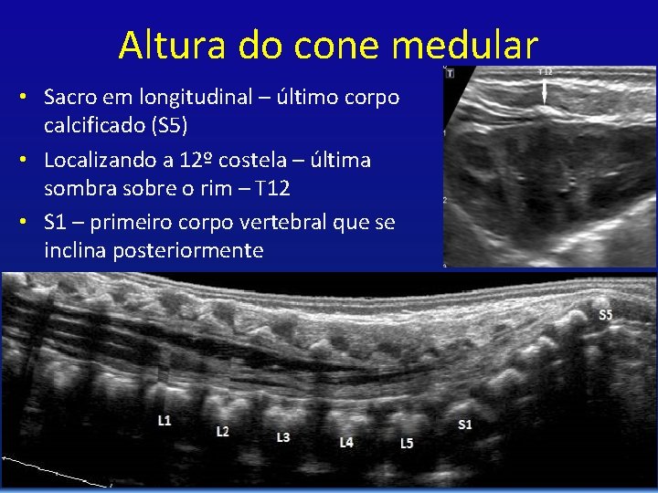 ULTRASSONOGRAFIA DA MEDULA ESPINHAL NO RN Telma Sakuno