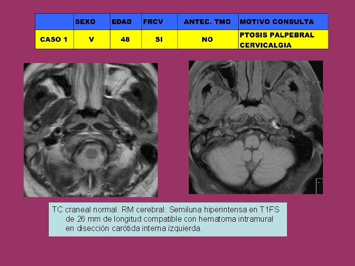 TC craneal normal RM cerebral Semiluna hiperintensa en