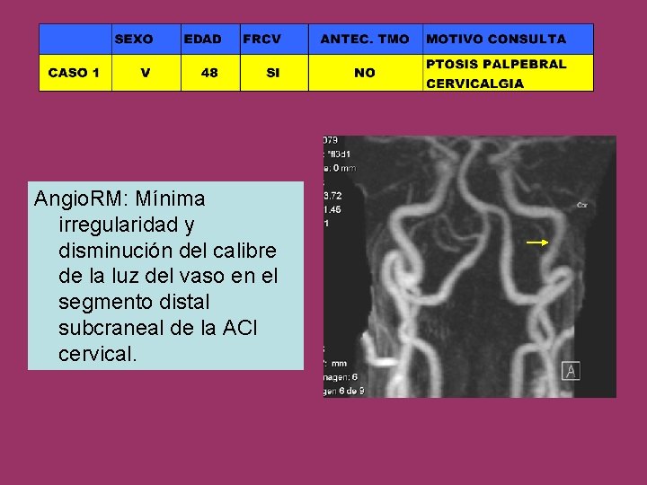 TC craneal normal RM cerebral Semiluna hiperintensa en