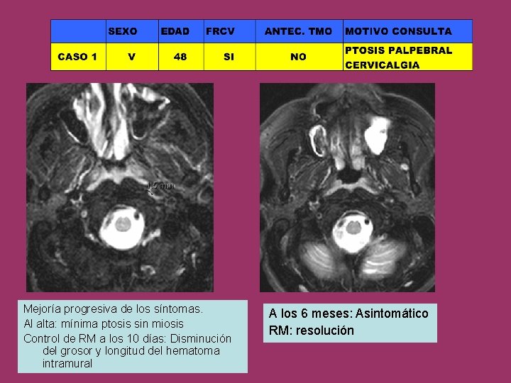 TC craneal normal RM cerebral Semiluna hiperintensa en