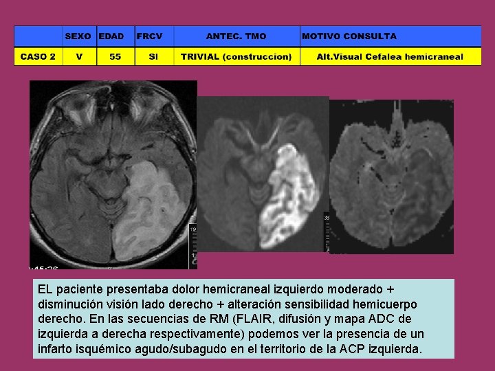 TC craneal normal RM cerebral Semiluna hiperintensa en