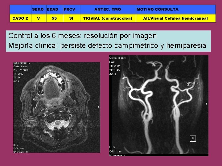 TC craneal normal RM cerebral Semiluna hiperintensa en