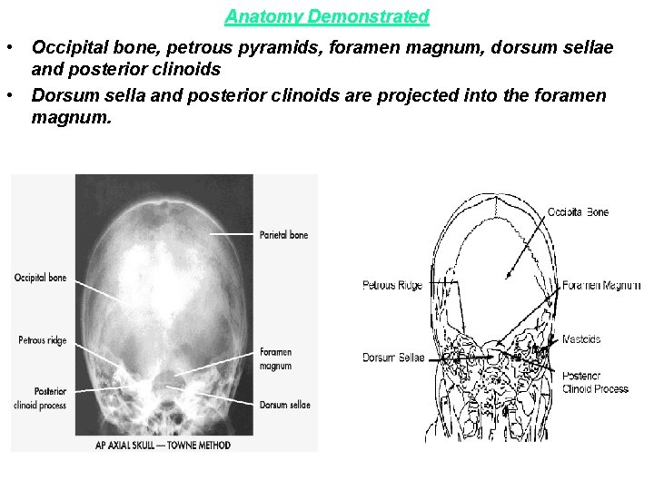 Lecture 27 Radiography of cranial Bones Basic 0Occipito