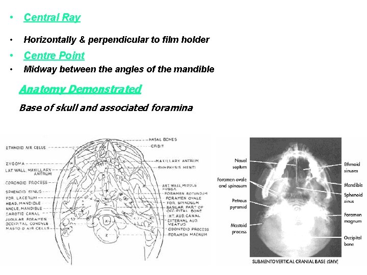 Lecture 27 Radiography of cranial Bones Basic 0Occipito